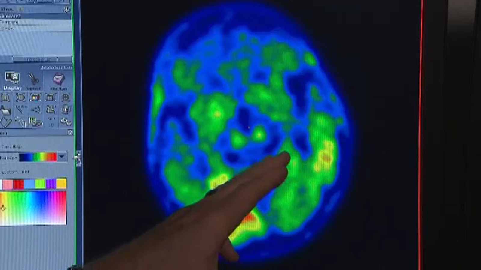 Study finds high levels of stress hormone may shrink brain - ABC7 New York