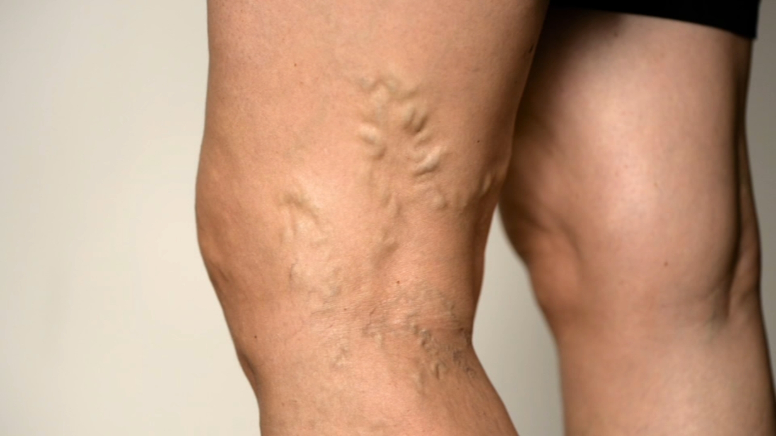 Today's Tip: Varicose Veins - 6abc Philadelphia