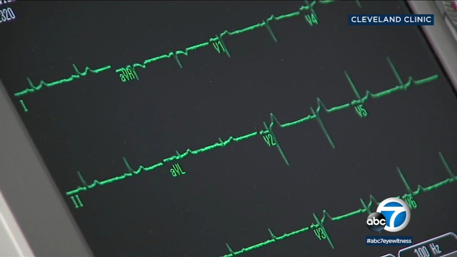 Study finds likelihood of heart attacks increase during holidays - ABC7 ...