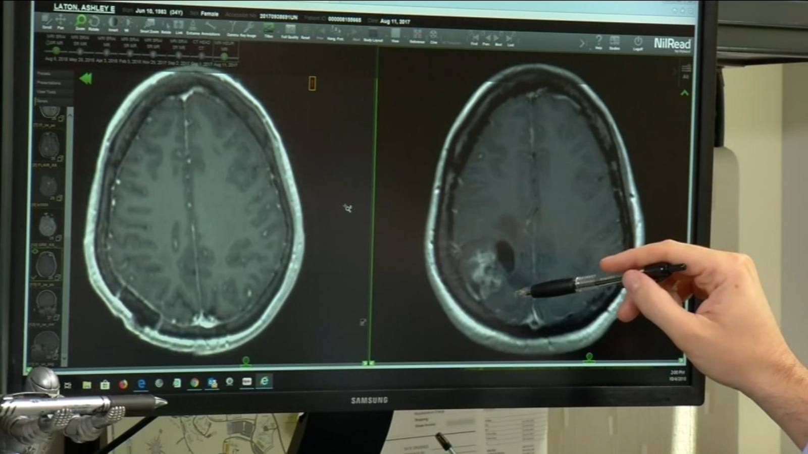 Health Watch: Battling brain tumors with Optune - ABC30 Fresno