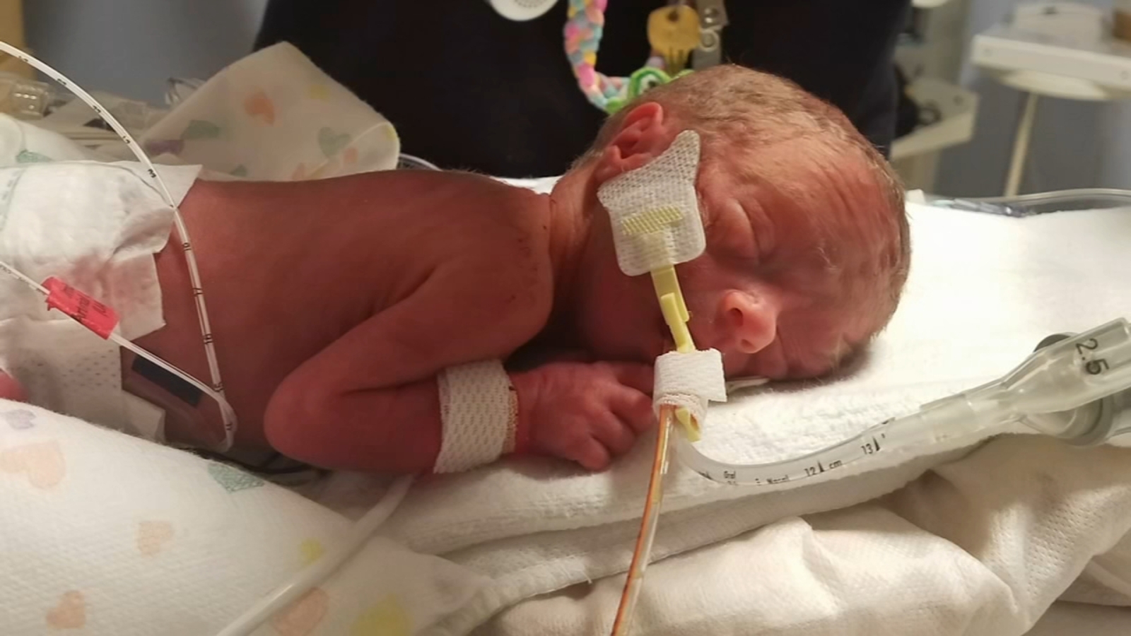 FDA approves new heart device for premature babies - 6abc Philadelphia