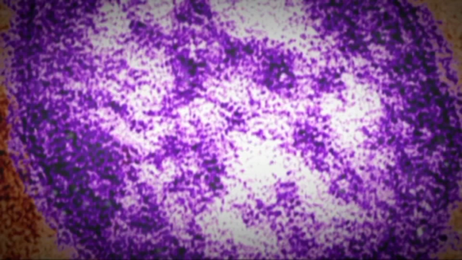Measles exposure possible at Midway Airport, Delnor Hospital in Geneva ...