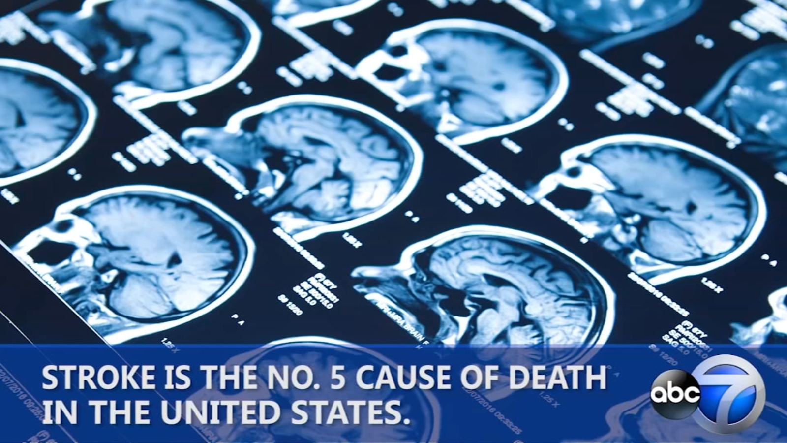 Stroke: How to spot the warning signs, symptoms - ABC7 New York