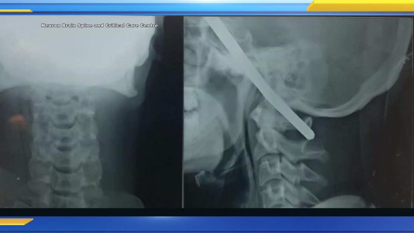 Man in India survives after falling onto rod at construction site ...