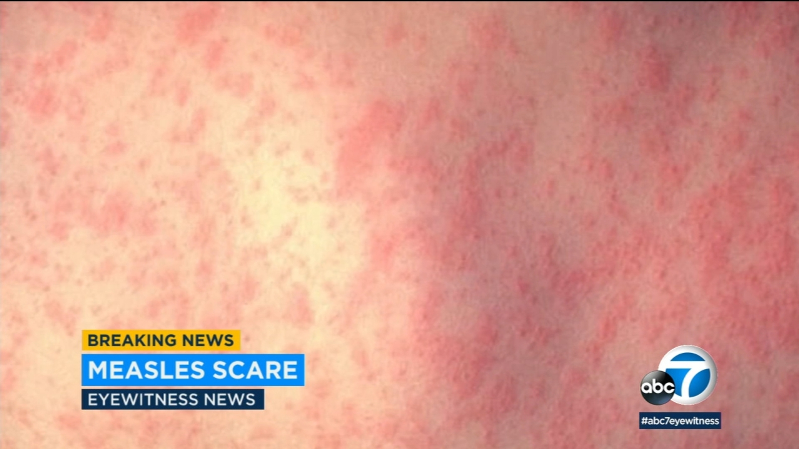 Measles outbreak rocks Cal State LA, UCLA with more than 700 ...