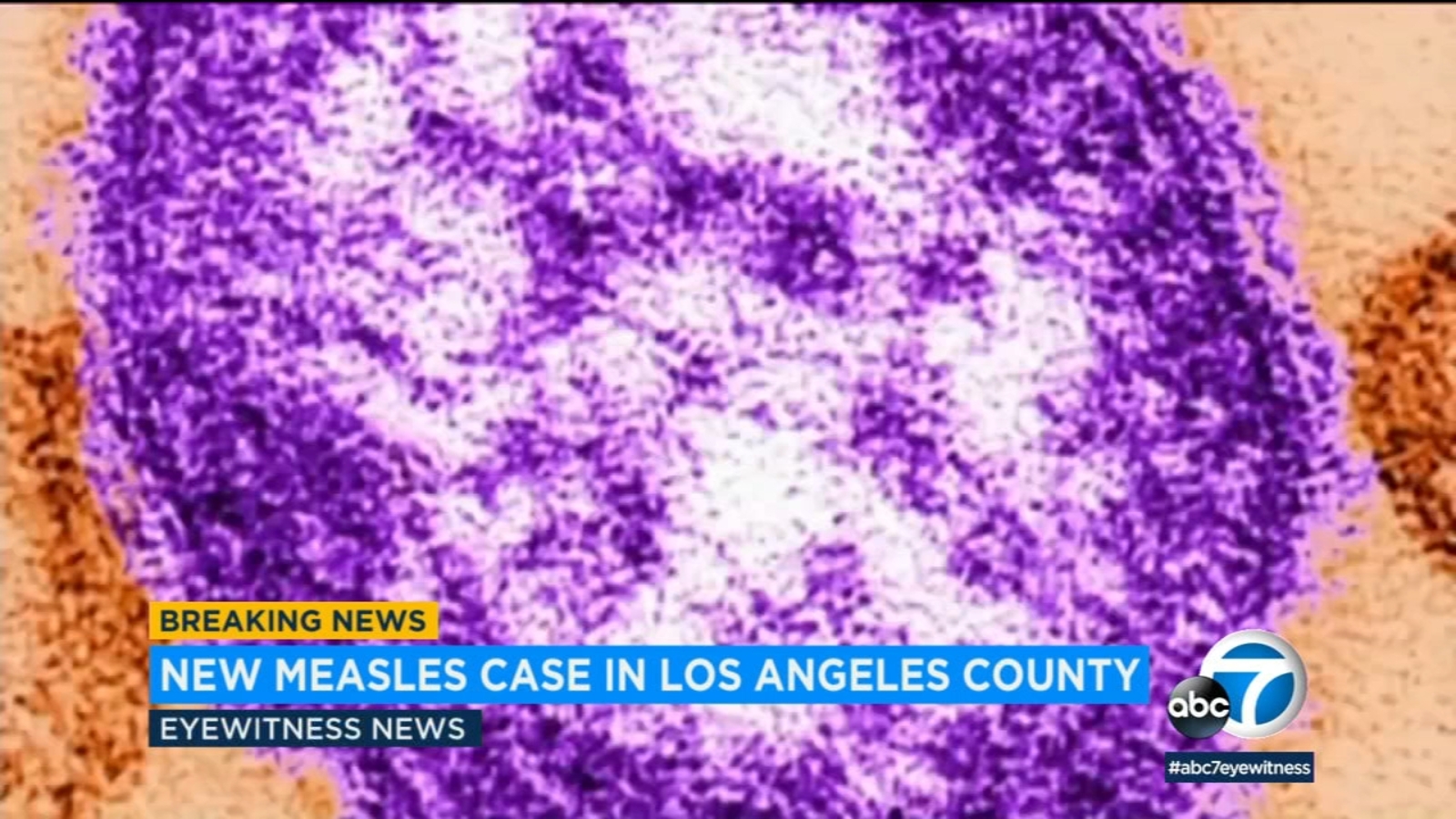 Measles outbreak: 6th case reported in LA County - ABC7 Los Angeles