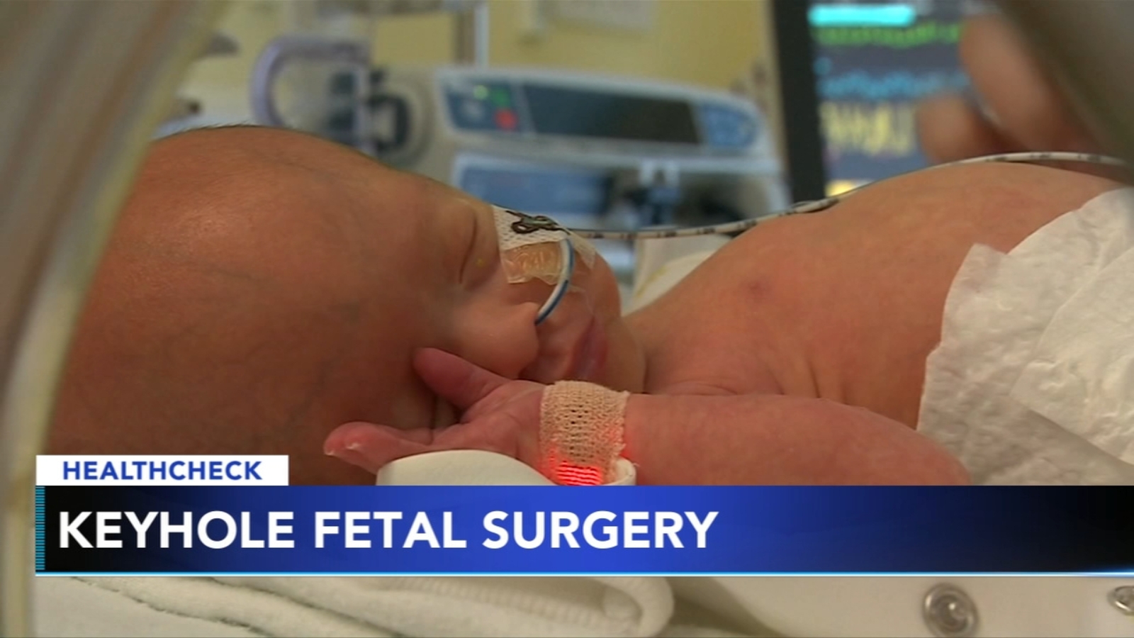 First laparoscopic surgery to fix defect in the womb - 6abc Philadelphia