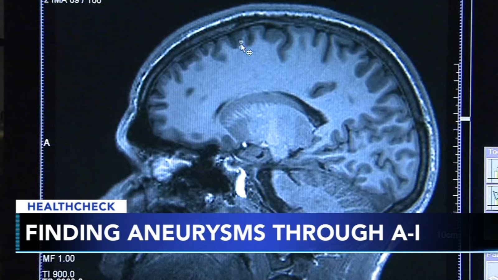 Artificial intelligence tested in diagnosing aneurysms - 6abc Philadelphia