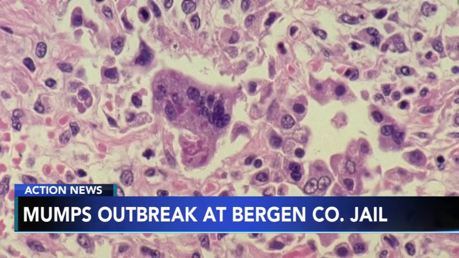 County jail with 5 suspected mumps cases quarantined - 6abc Philadelphia