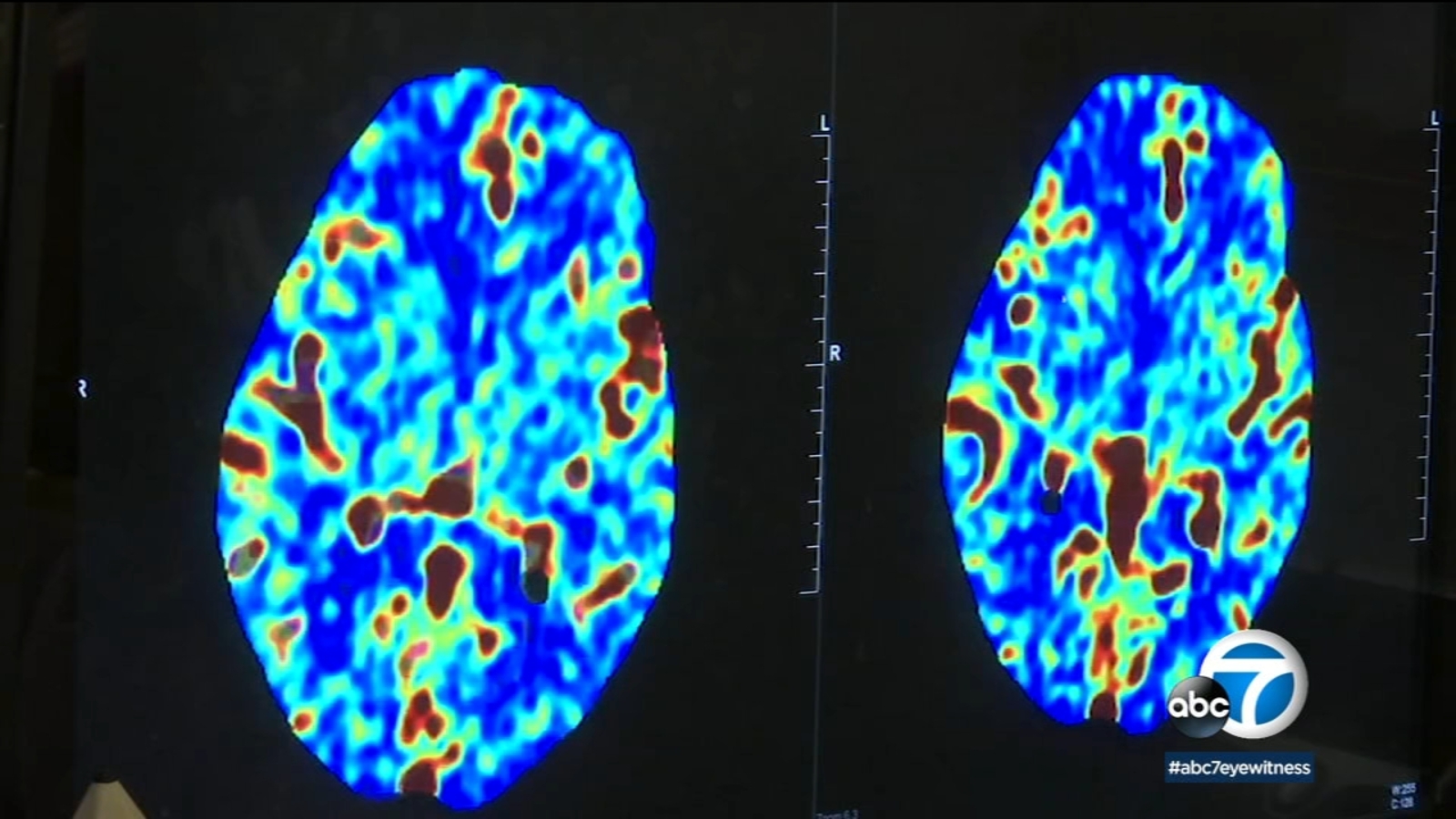 Stroke research: UCLA scientists studying AIDS drug to accelerate ...