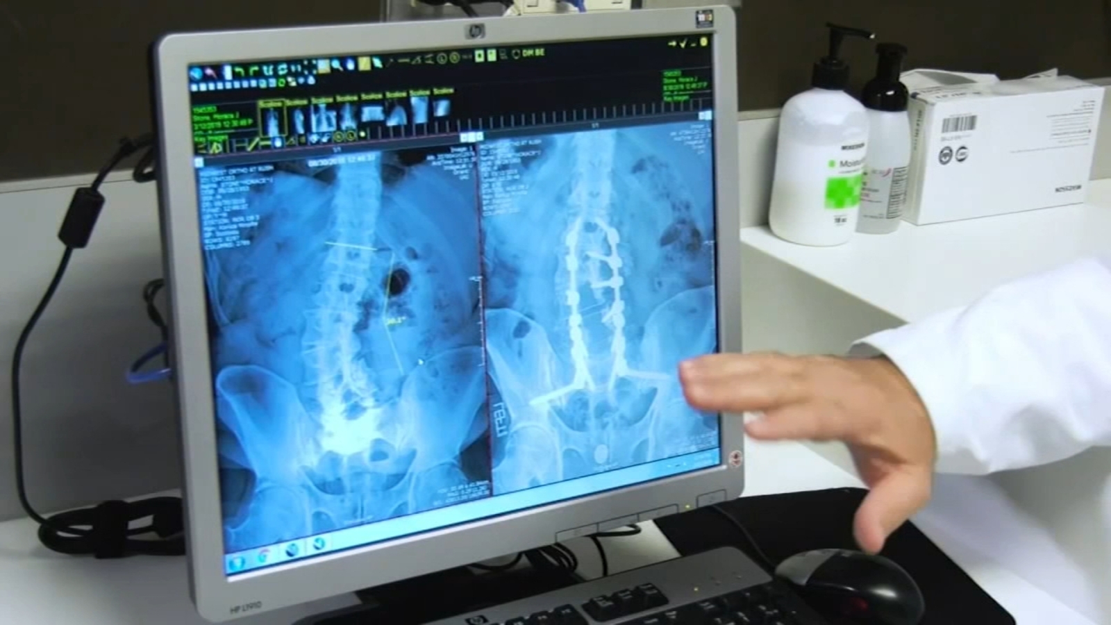 Health Watch: Robotic Spine Surgery - ABC30 Fresno