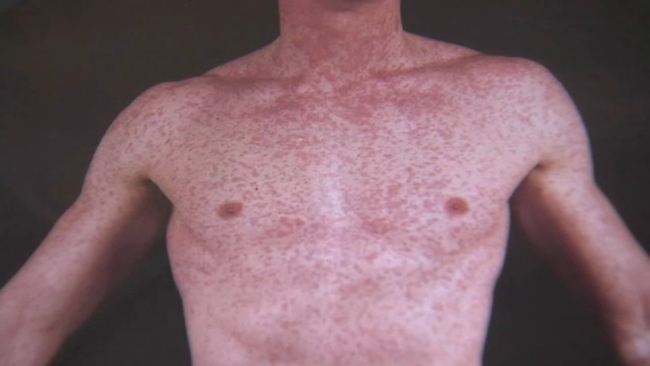 Measles: Symptoms, vaccine and treatment facts to know | abc7.com
