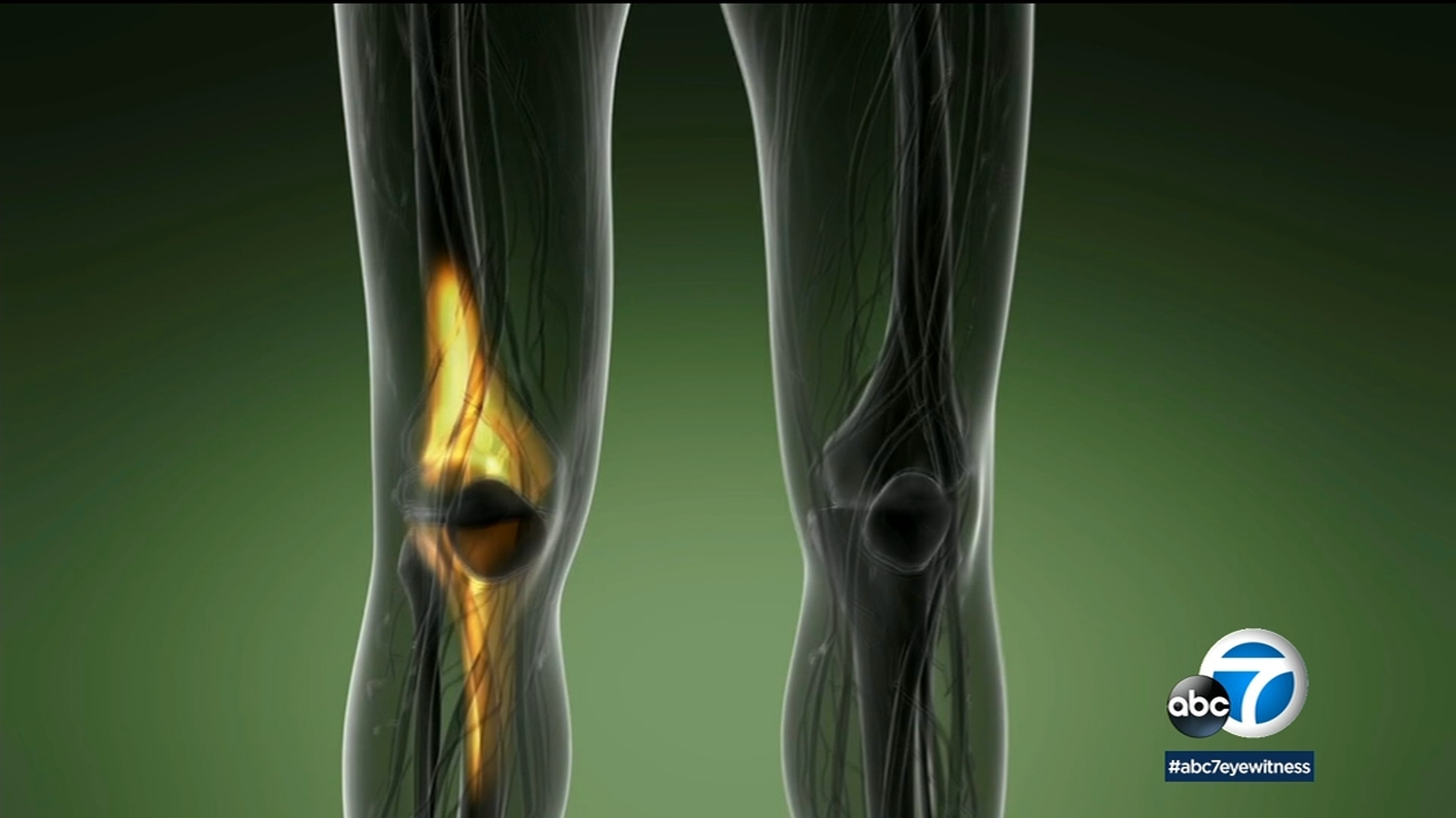 Do you need a joint replacement? Here are the questions to ask yourself ...