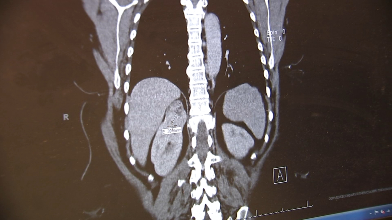 Expert discusses importance of kidney-sparing surgery following New ...