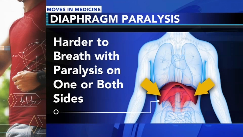 Diaphragm paralysis: What it is, diagnosis, prevention and treatment ...