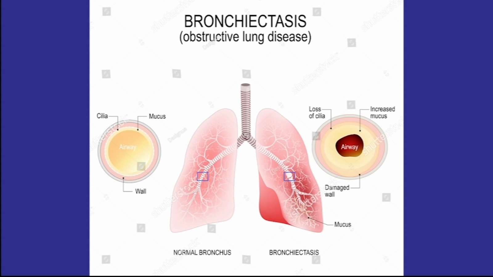 Bronchiectasis Symptoms Diagnosis Causes And How Temple Health Treatment Can Eliminate That